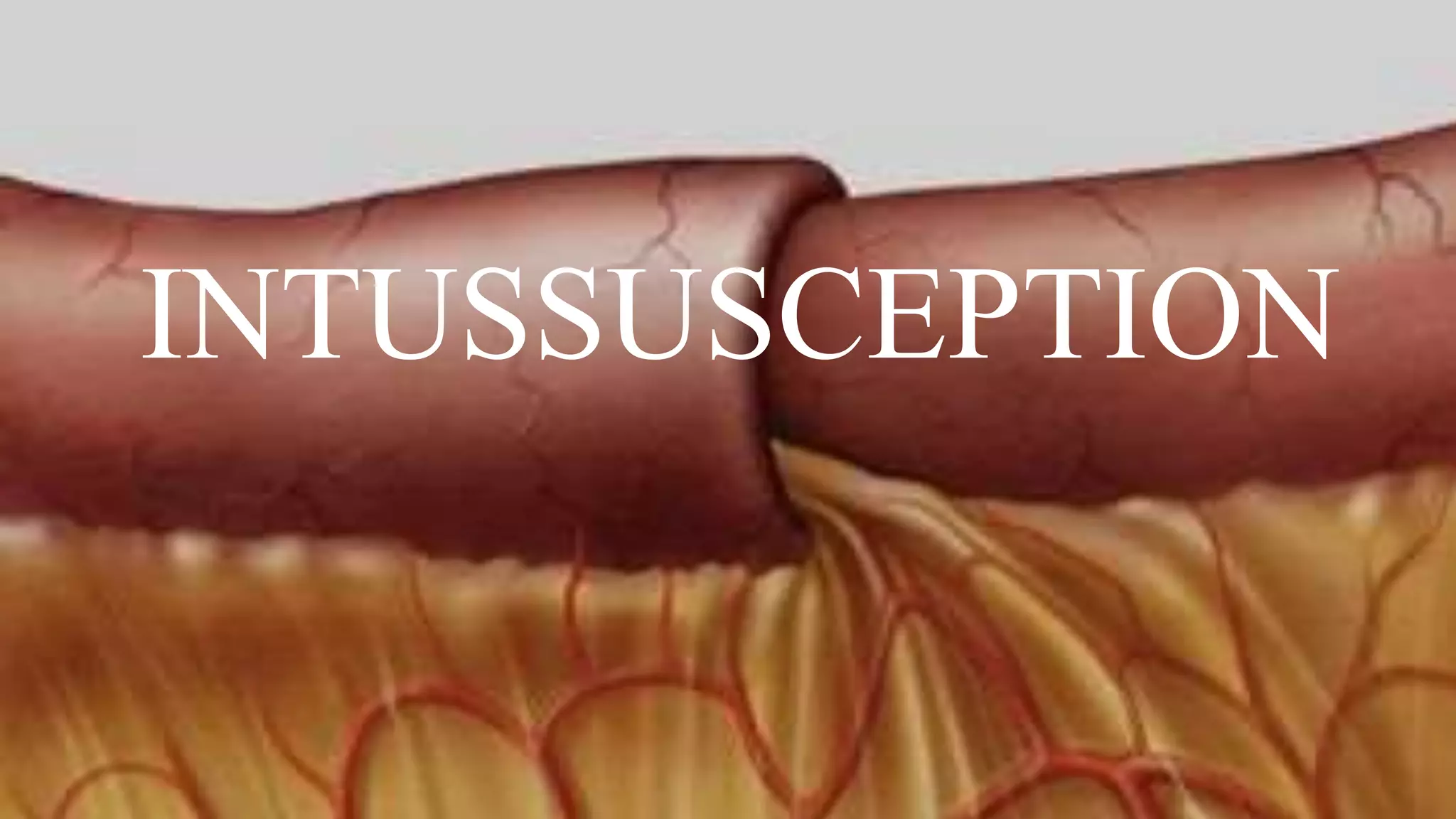 intussusception.pptx