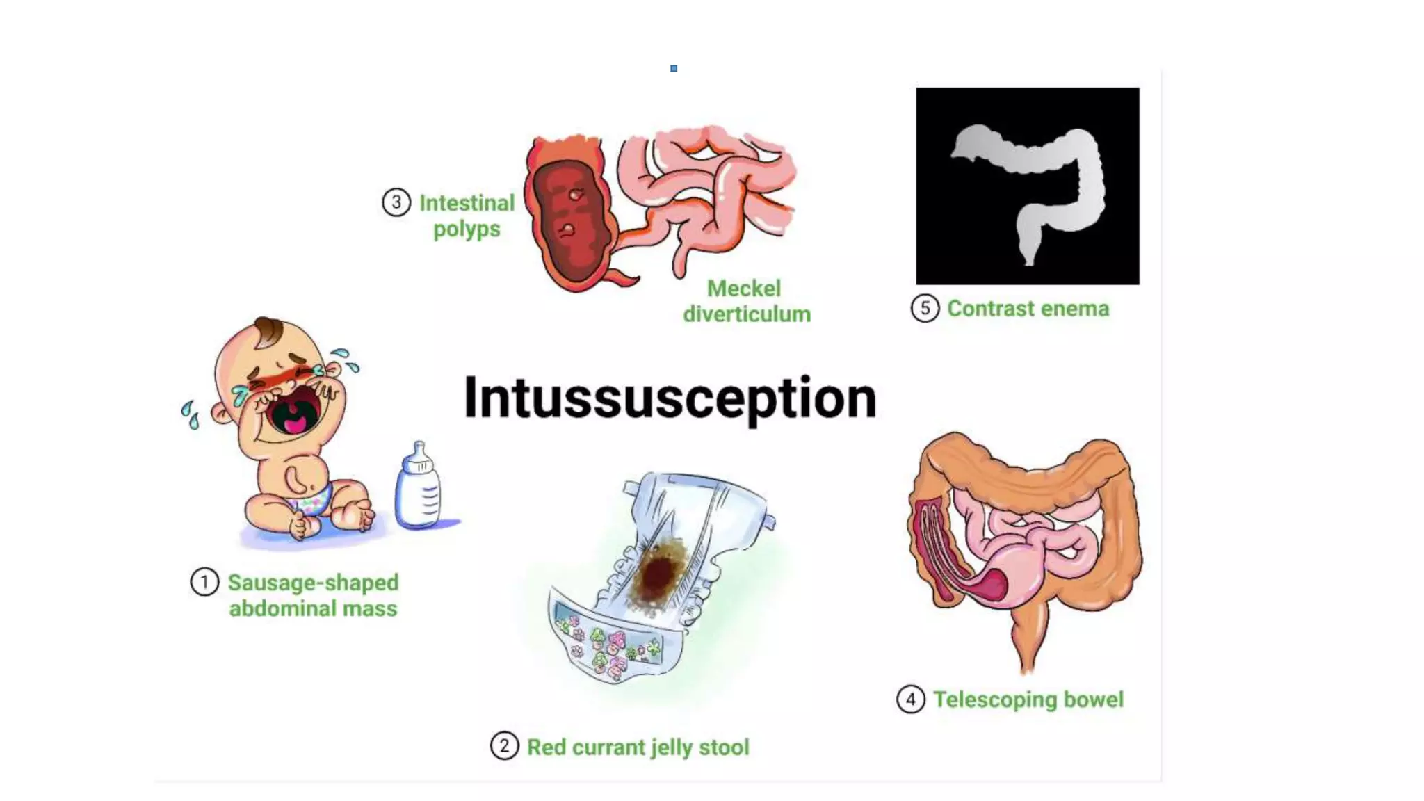 intussusception.pptx
