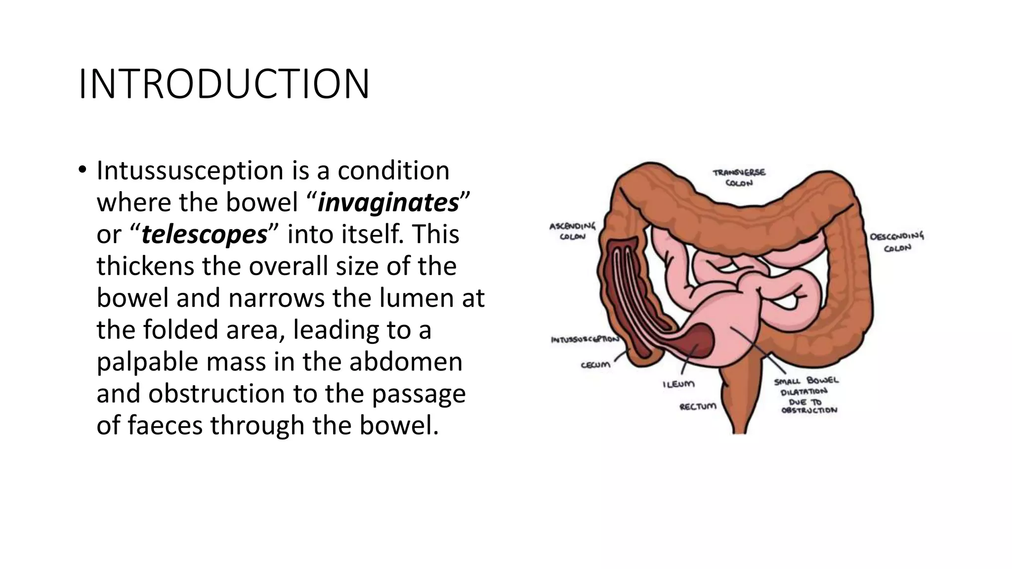 intussusception.pptx | Digestive Disorders | Diseases and Conditions