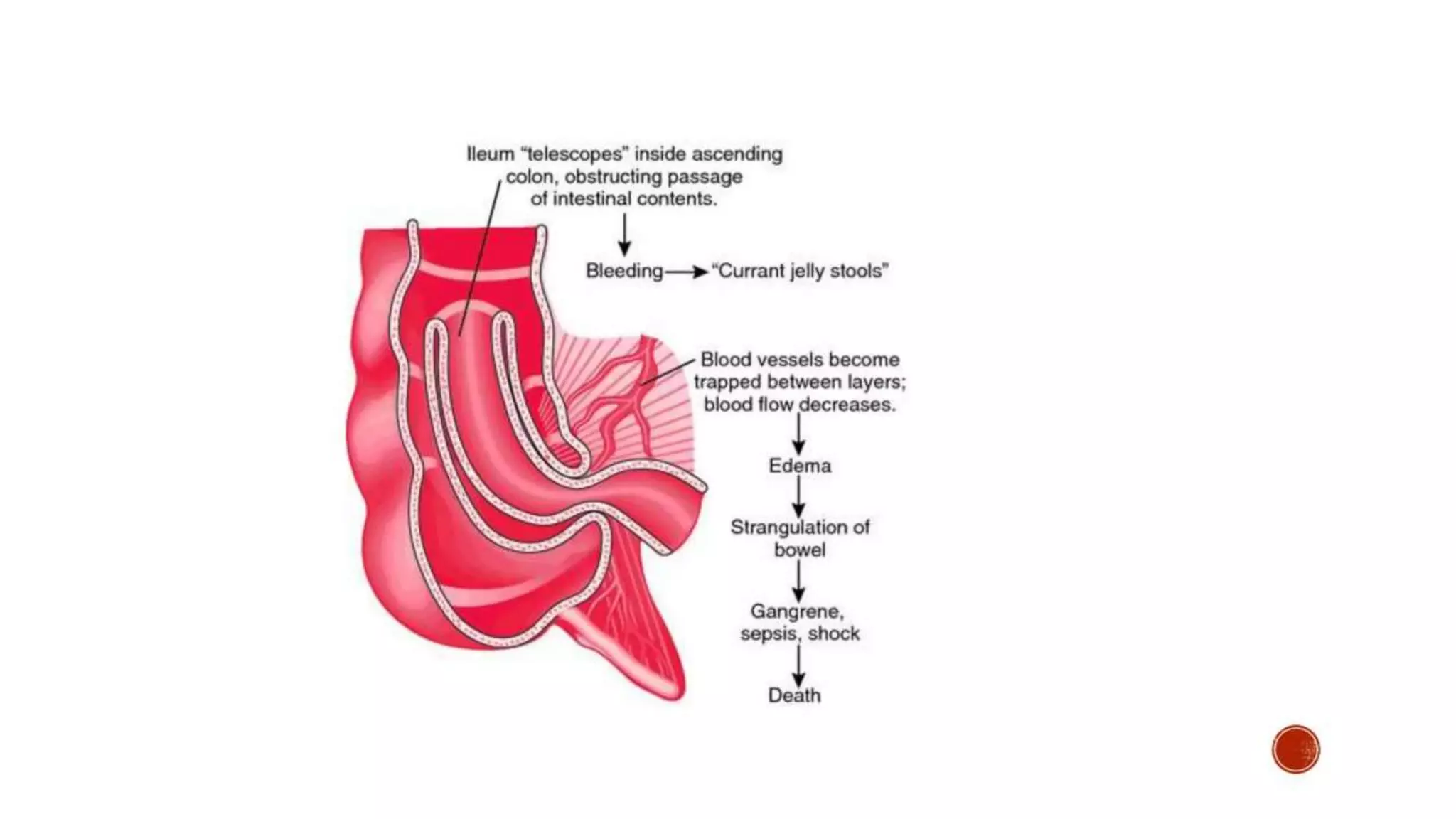 intussusception.pptx | Digestive Disorders | Diseases and Conditions