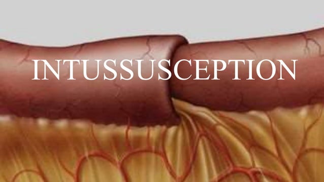 intussusception.pptx
