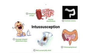intussusception.pptx | Digestive Disorders | Diseases and Conditions