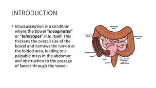intussusception.pptx | Digestive Disorders | Diseases and Conditions