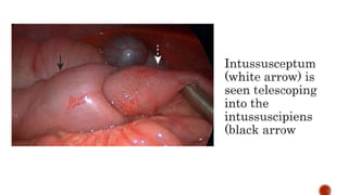 intussusception.pptx | Digestive Disorders | Diseases and Conditions