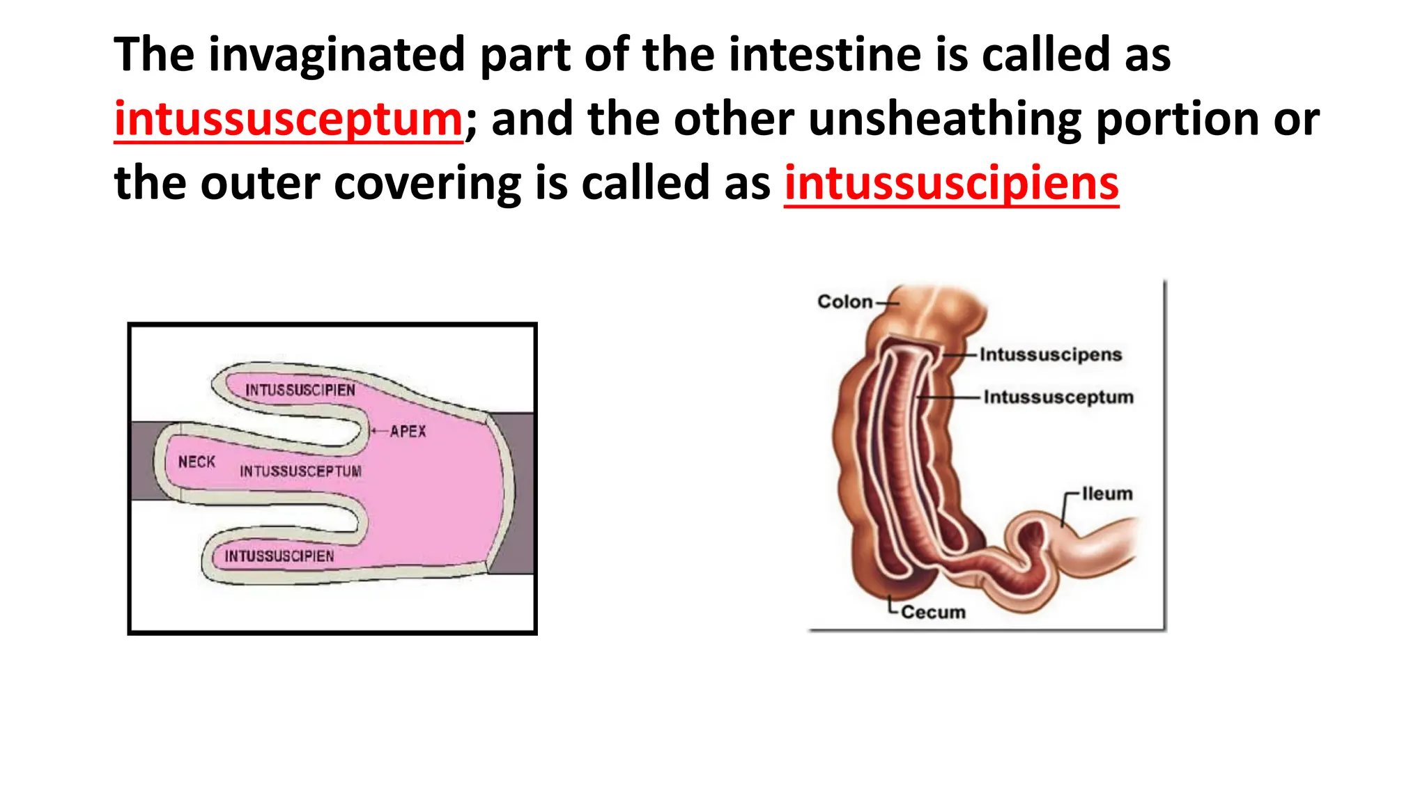 INTUSSUSCEPTION.pdf