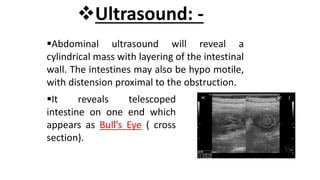 INTUSSUSCEPTION.pdf