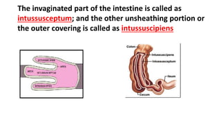 INTUSSUSCEPTION.pdf