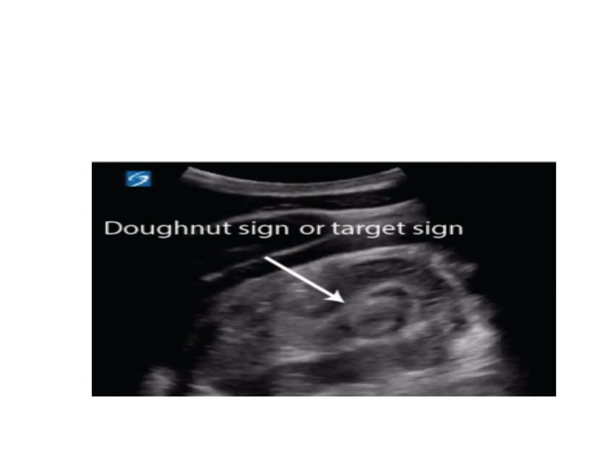intussusception.pdf