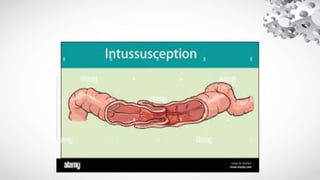 INTUSSUSCEPTION.pptx, introduction to the pathologies of the git | PPT