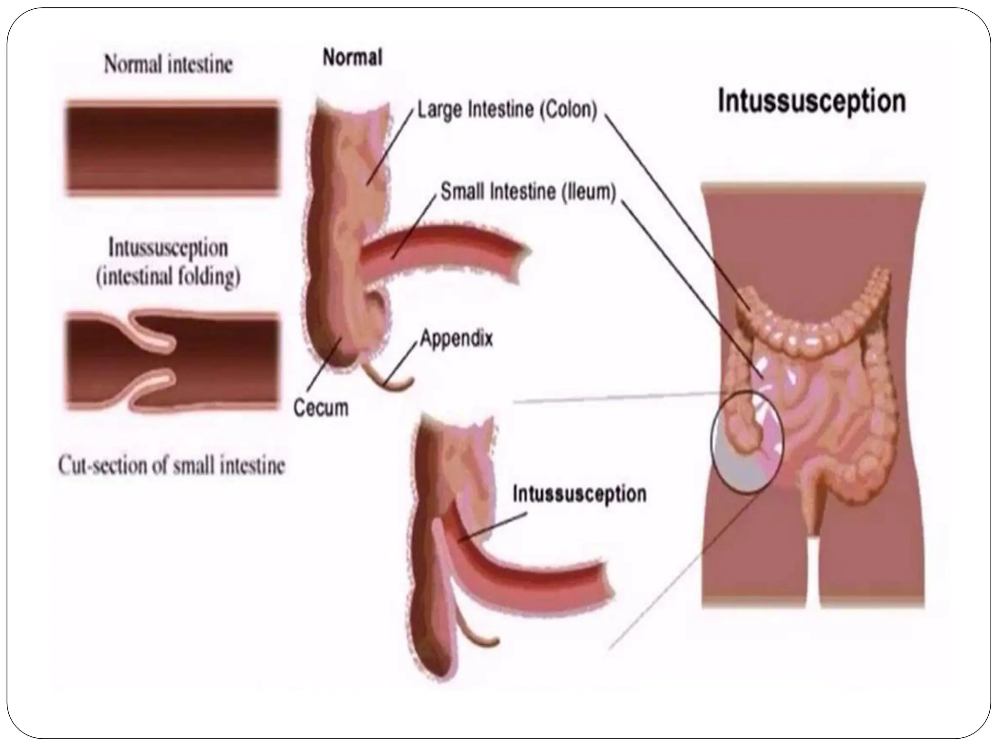 GI obstructive condition -Intussusception.pptx