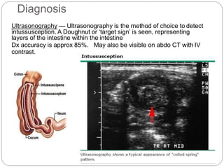 GI obstructive condition -Intussusception.pptx | Digestive Disorders ...