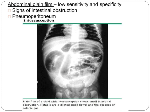 GI obstructive condition -Intussusception.pptx