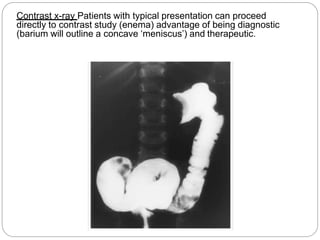 GI obstructive condition -Intussusception.pptx | Digestive Disorders | Diseases and Conditions