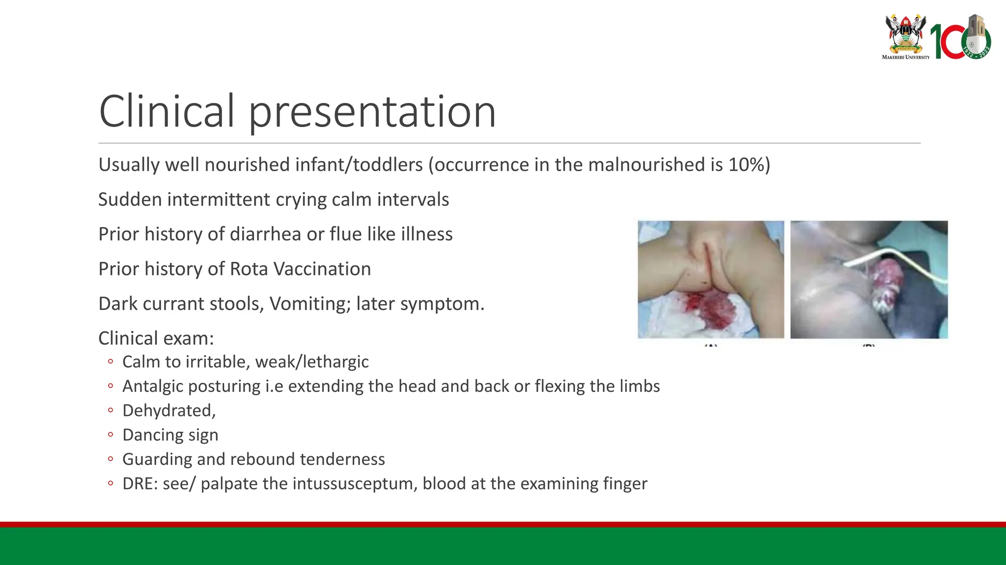 Neonatal intestinal Obstruction_ Intussusception.pptx