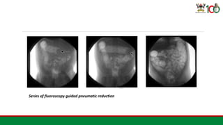 Neonatal intestinal Obstruction_ Intussusception.pptx