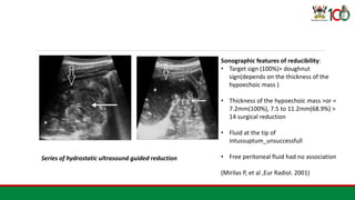 Neonatal intestinal Obstruction_ Intussusception.pptx