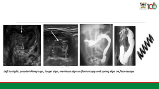 Neonatal intestinal Obstruction_ Intussusception.pptx