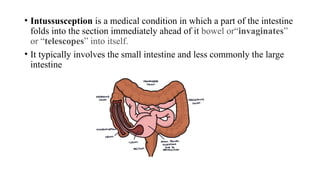 Intussusception.pptx SURGERY PRESENTATION | PPT