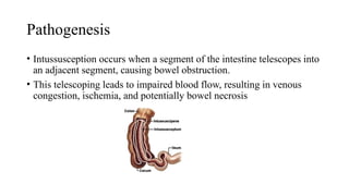 Intussusception.pptx SURGERY PRESENTATION | PPT