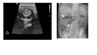 Intussusception.pptx SURGERY PRESENTATION | PPT