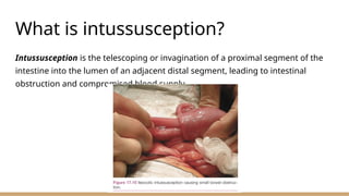 Intussusception - 4th year MBBS GENERAL SURGERY TOPIC | PPTX