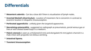 Intussusception case presentation radiology | PPTX