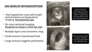 Intussusception case presentation radiology | PPTX
