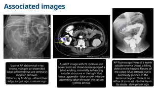 Intussusception case presentation radiology | PPTX