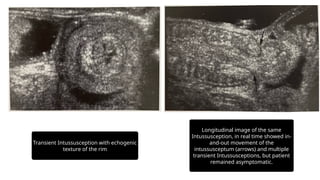 Intussusception case presentation radiology | PPTX