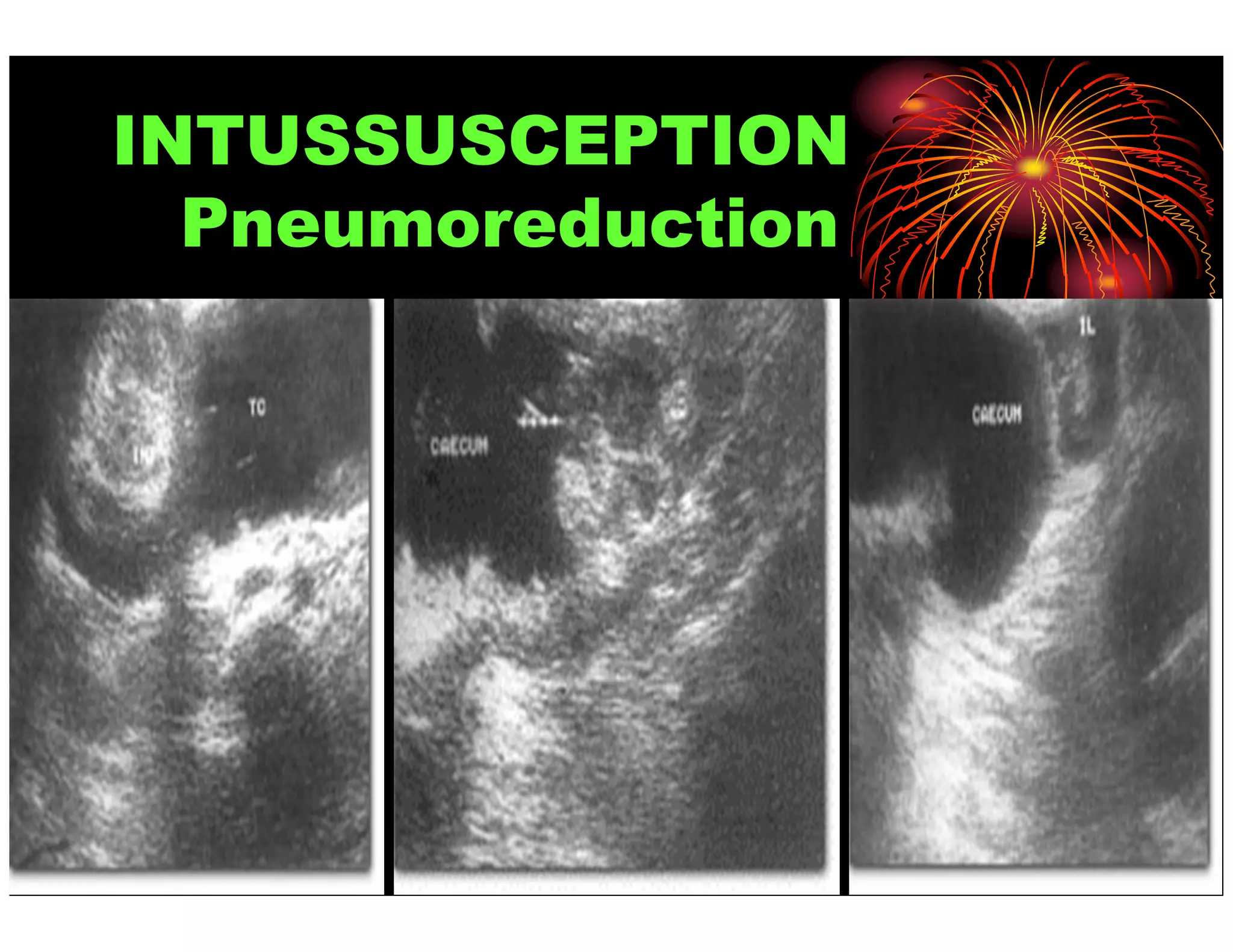 Pediatric Intussusception - An Overview | PDF