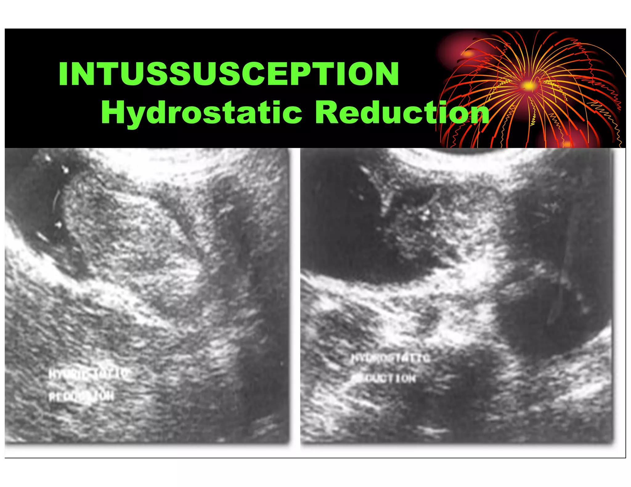 Pediatric Intussusception - An Overview | PPT
