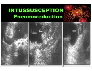 Pediatric Intussusception - An Overview | PDF