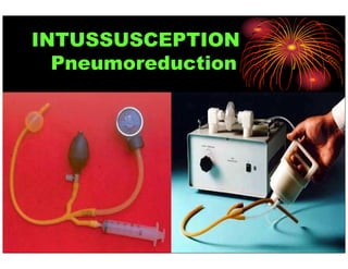 Pediatric Intussusception - An Overview | PPT