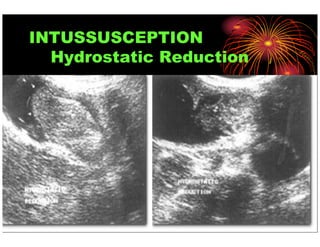 Pediatric Intussusception - An Overview | PDF