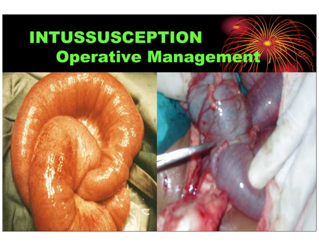 Pediatric Intussusception - An Overview | PDF | Digestive Disorders ...