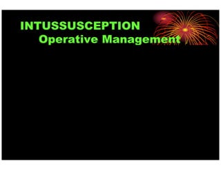 Pediatric Intussusception - An Overview | PDF