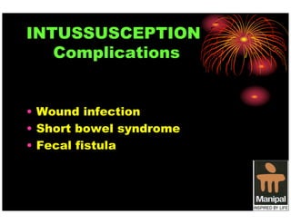 Pediatric Intussusception - An Overview | PDF