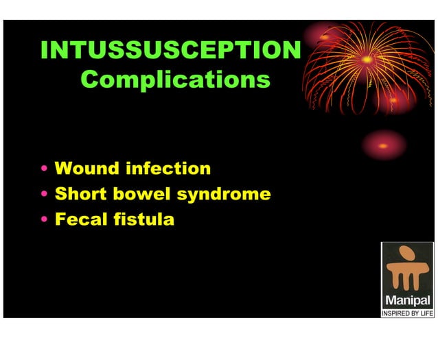 Pediatric Intussusception - An Overview | PDF | Digestive Disorders | Diseases and Conditions