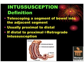 Pediatric Intussusception - An Overview | PDF