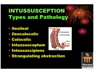 Pediatric Intussusception - An Overview | PDF