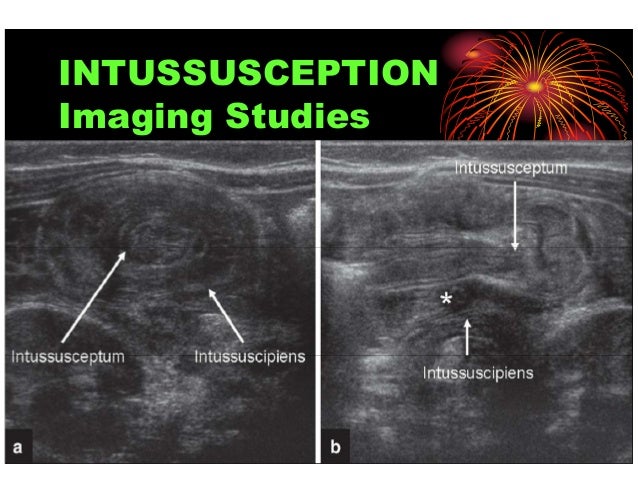Pediatric Intussusception - An Overview