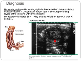 Intussusception (2) | PDF