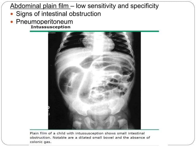 Intussusception (2) | PDF