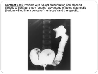 Intussusception (2) | PDF