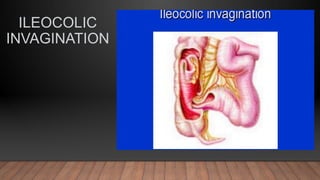Basic on intussusception Pediatrics note | PPTX