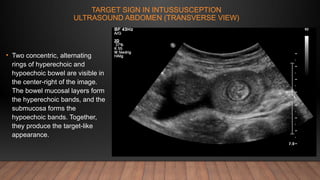 Basic on intussusception Pediatrics note | PPT