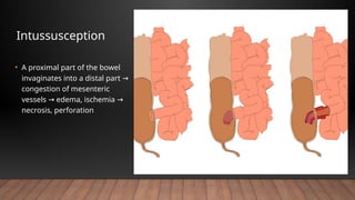 Basic on intussusception Pediatrics note | PPT