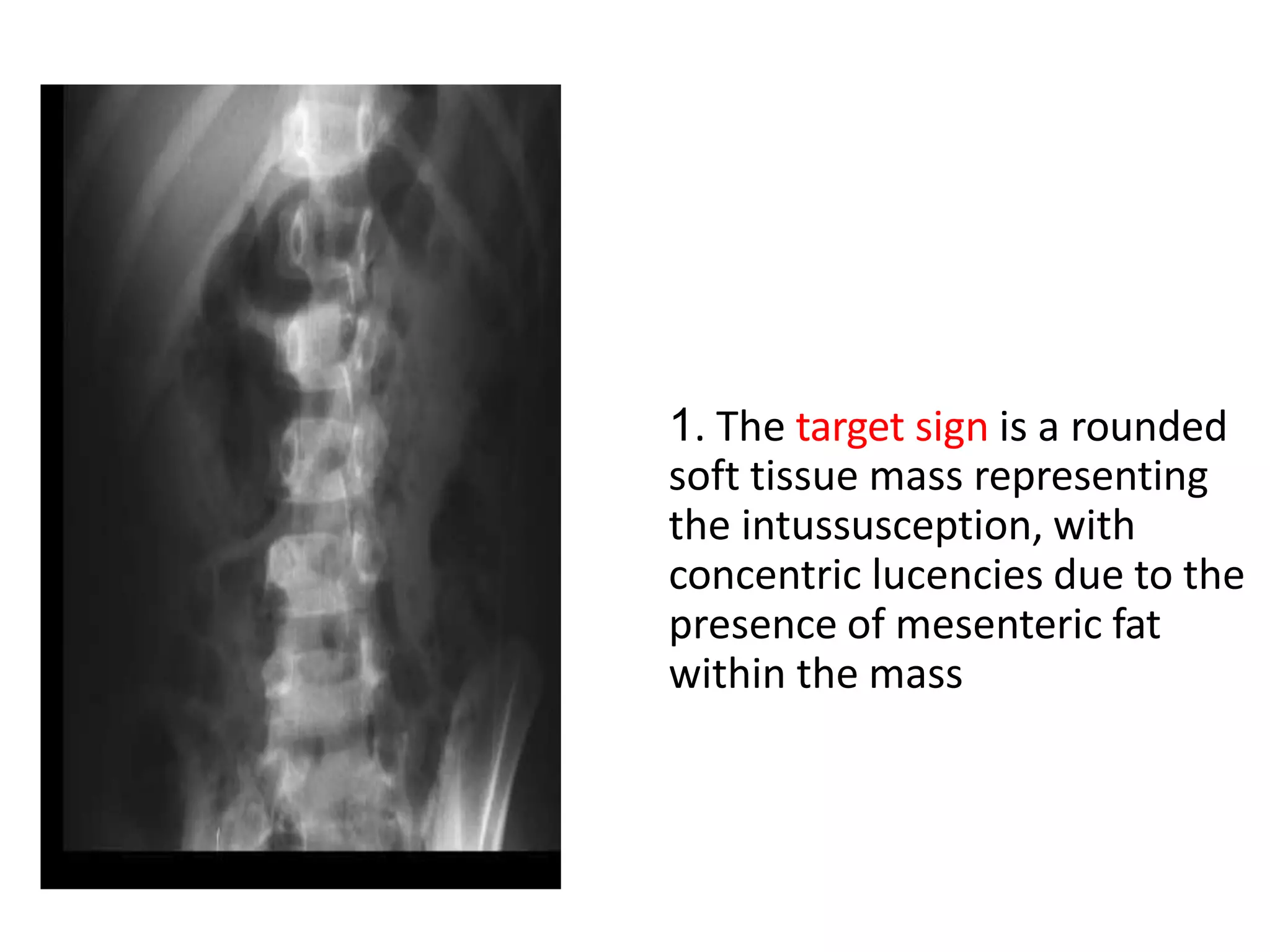 intussusceptIon | PPT