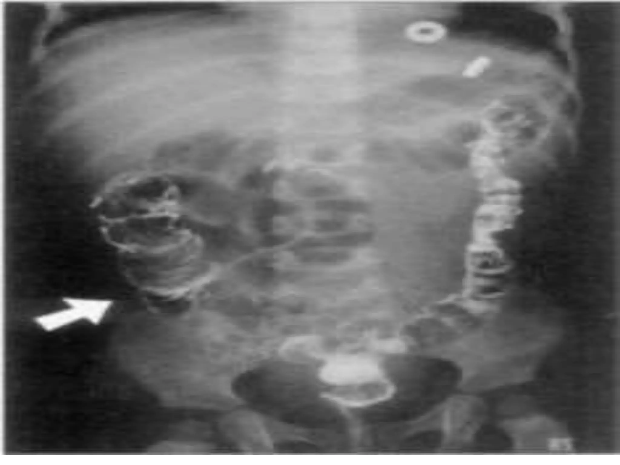 intussusceptIon | PPTX