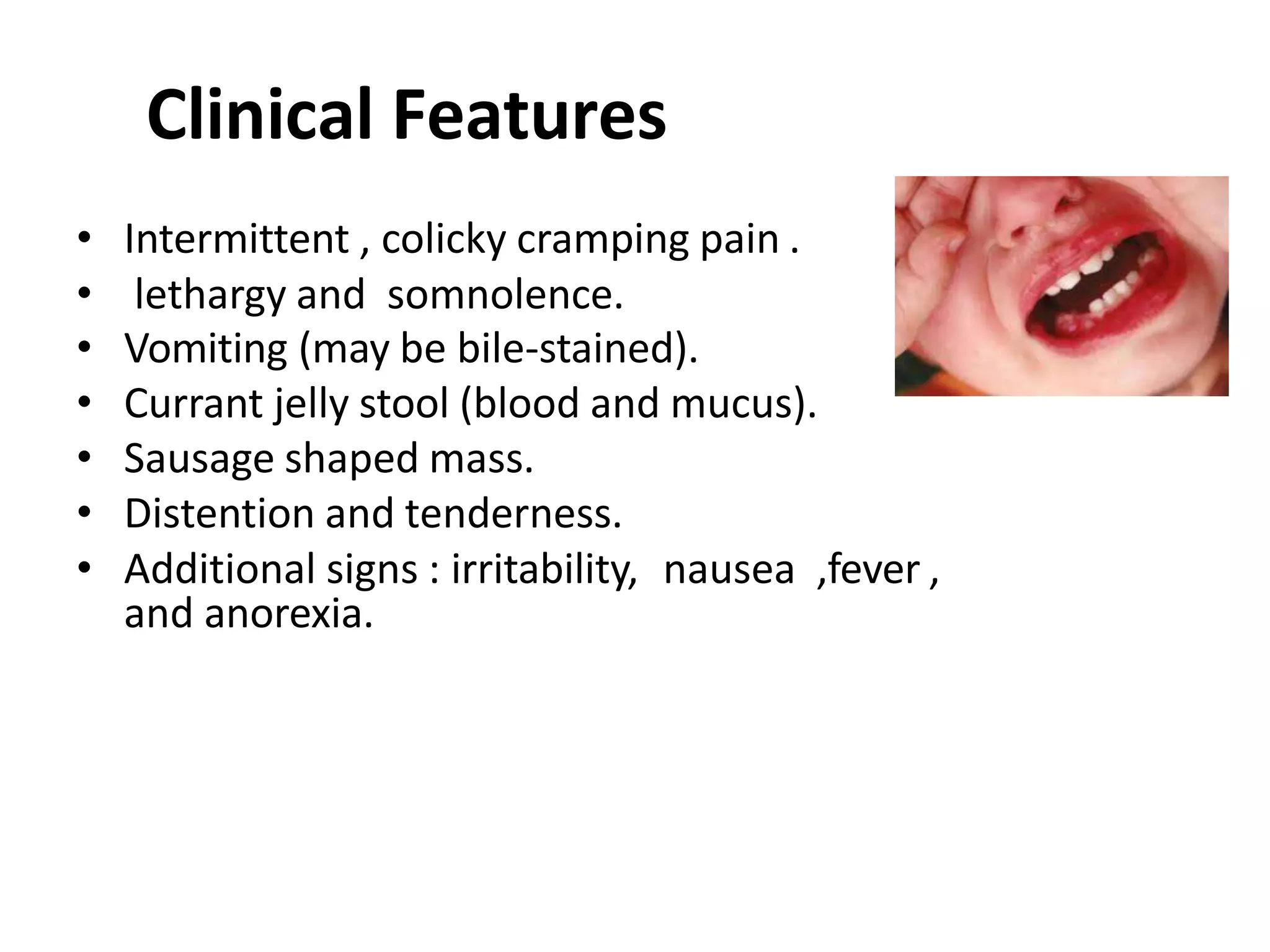 intussusceptIon | PPTX